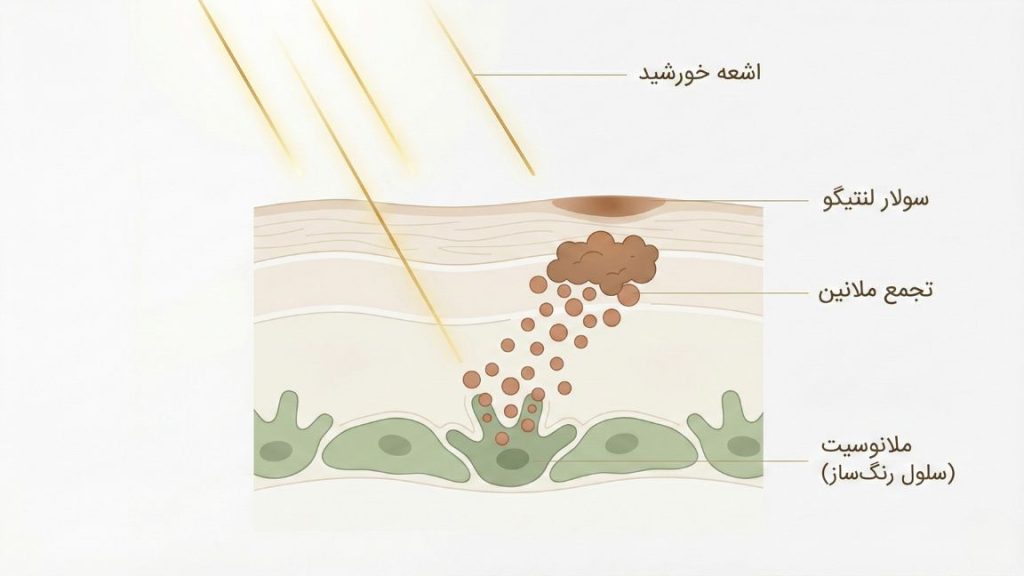 سولار لنتیگو: لکه‌های قهوه‌ای که با سن یا آفتاب می‌آیند | هانا لایف